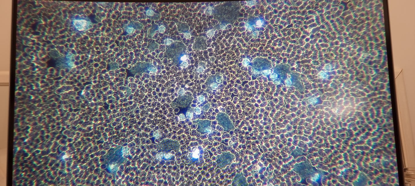 Exploding gel bubbles and WBC's, Glaucoma meds, bot breath and sundry.