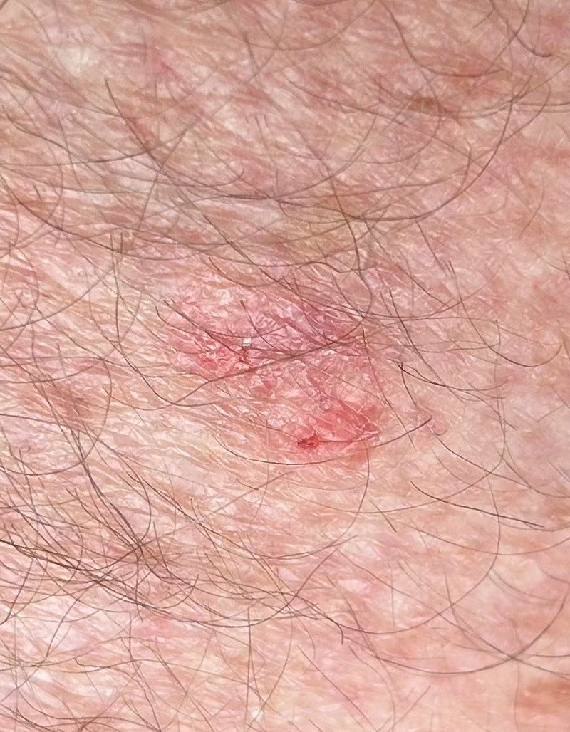 Skin dermatology getting personal - by Richard McKenzie