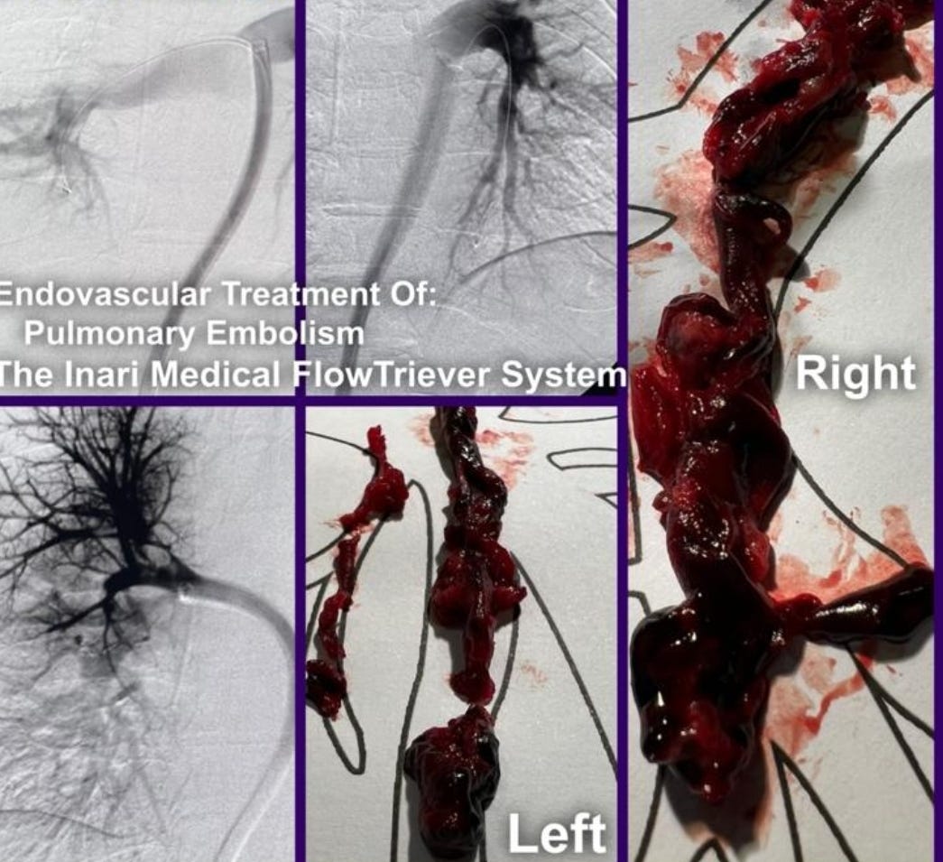 Dr. Phillip McMillan: Update on Embalmers Clots in the Living!