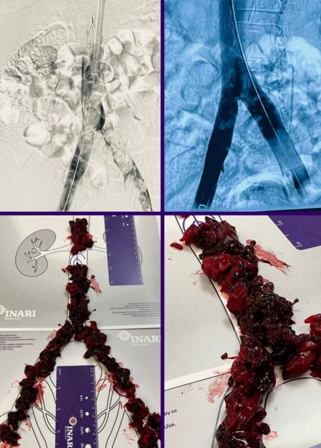 Dr. Phillip McMillan: Update on Embalmers Clots in the Living!