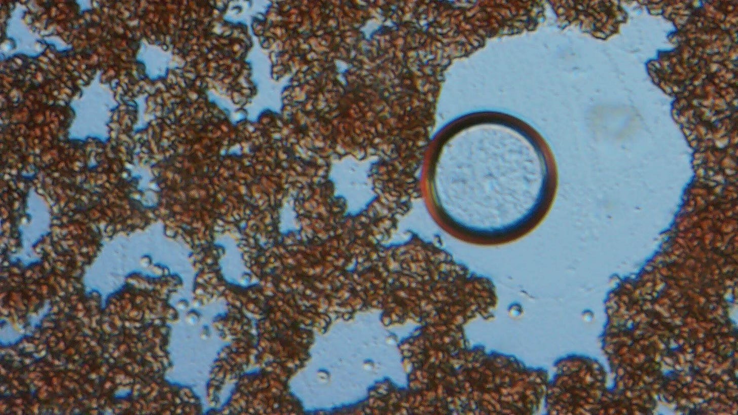 Morgellons Like Filament Tumor Found In Nasal Cavity With Insect ...