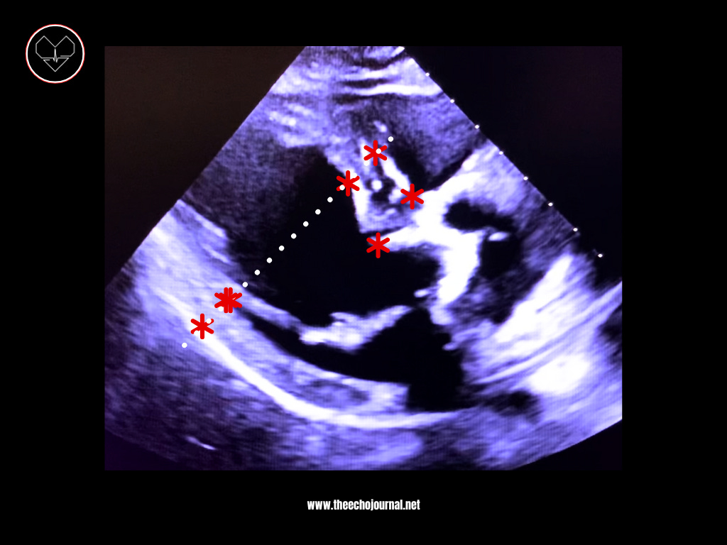 What is a Sigmoid Septum? - The Echo Journal