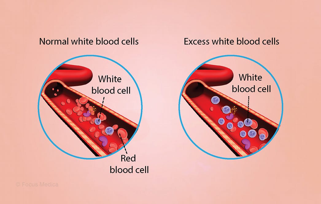 Acute lymphoblastic leukemia - by Survivor