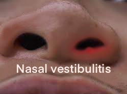 Nasal vestibulitis: The red and tender nose – Dr. Preethi Umamaheswaran ...