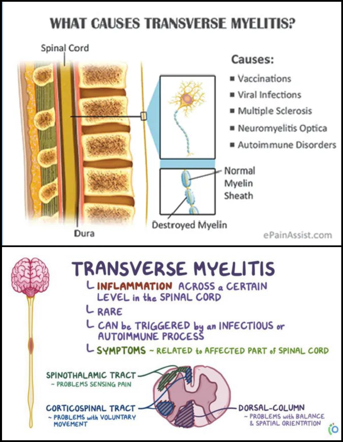 Transverse Myelitis - severe neurological injury caused by COVID-19 ...