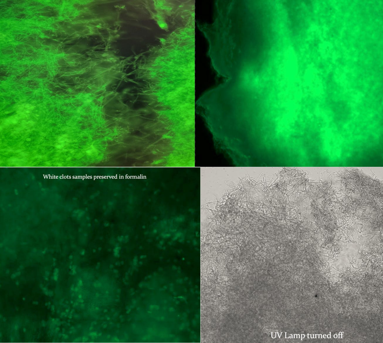 Microscopic and Biochemical Analysis of Anomalous White Fibrous Clots ...