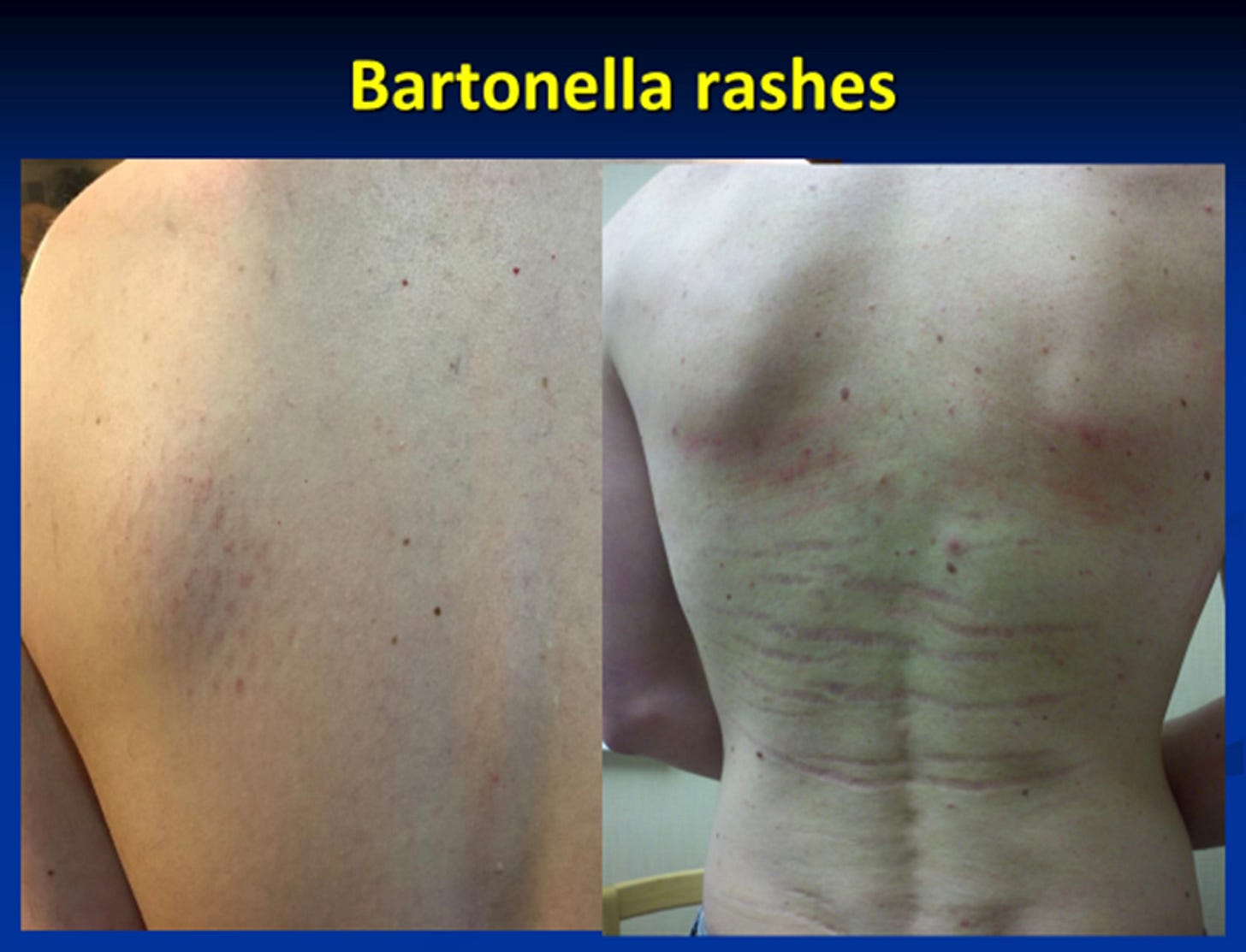 MEDICAL DETECTIVE: Establishing the diagnosis of Bartonella