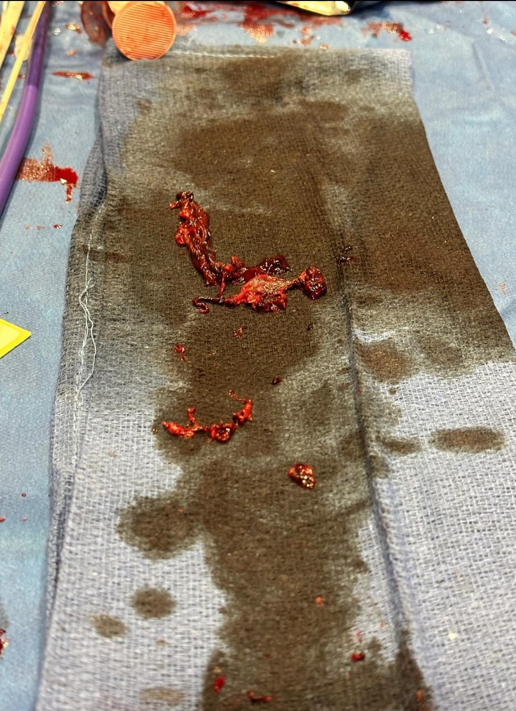 Dr. Phillip McMillan: Update on Embalmers Clots in the Living!