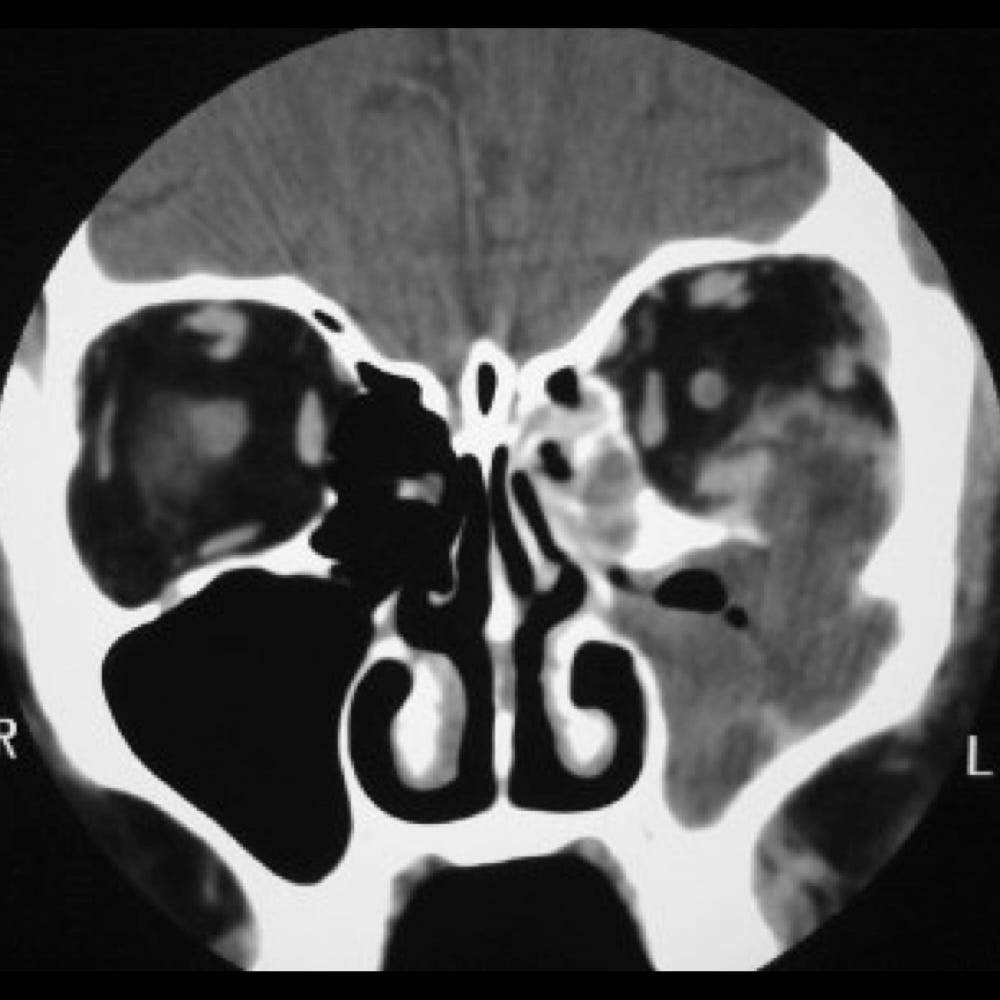 Inflammatory sinus disease - by Alexander Baxter - RadNotes