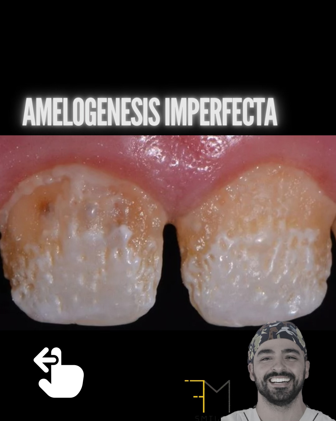 Ep.9 Amelogenesis Imperfecta