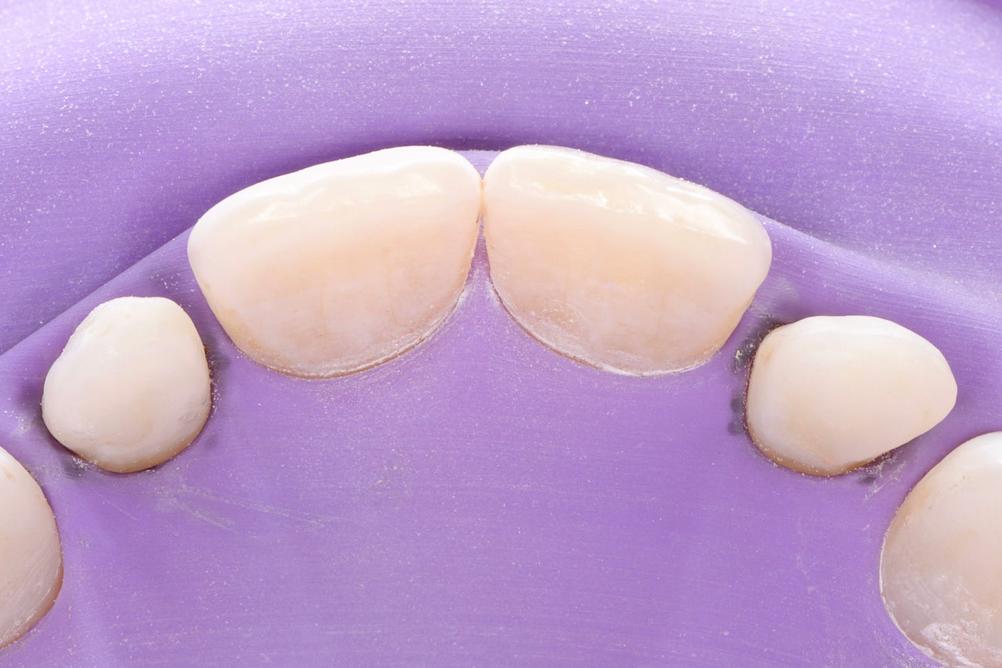 Peg Lateral Rejuvenation - by Brandon Walker, D.D.S.