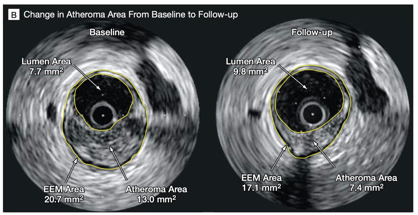 How To Reverse Coronary Artery Disease With Lifestyle Measures