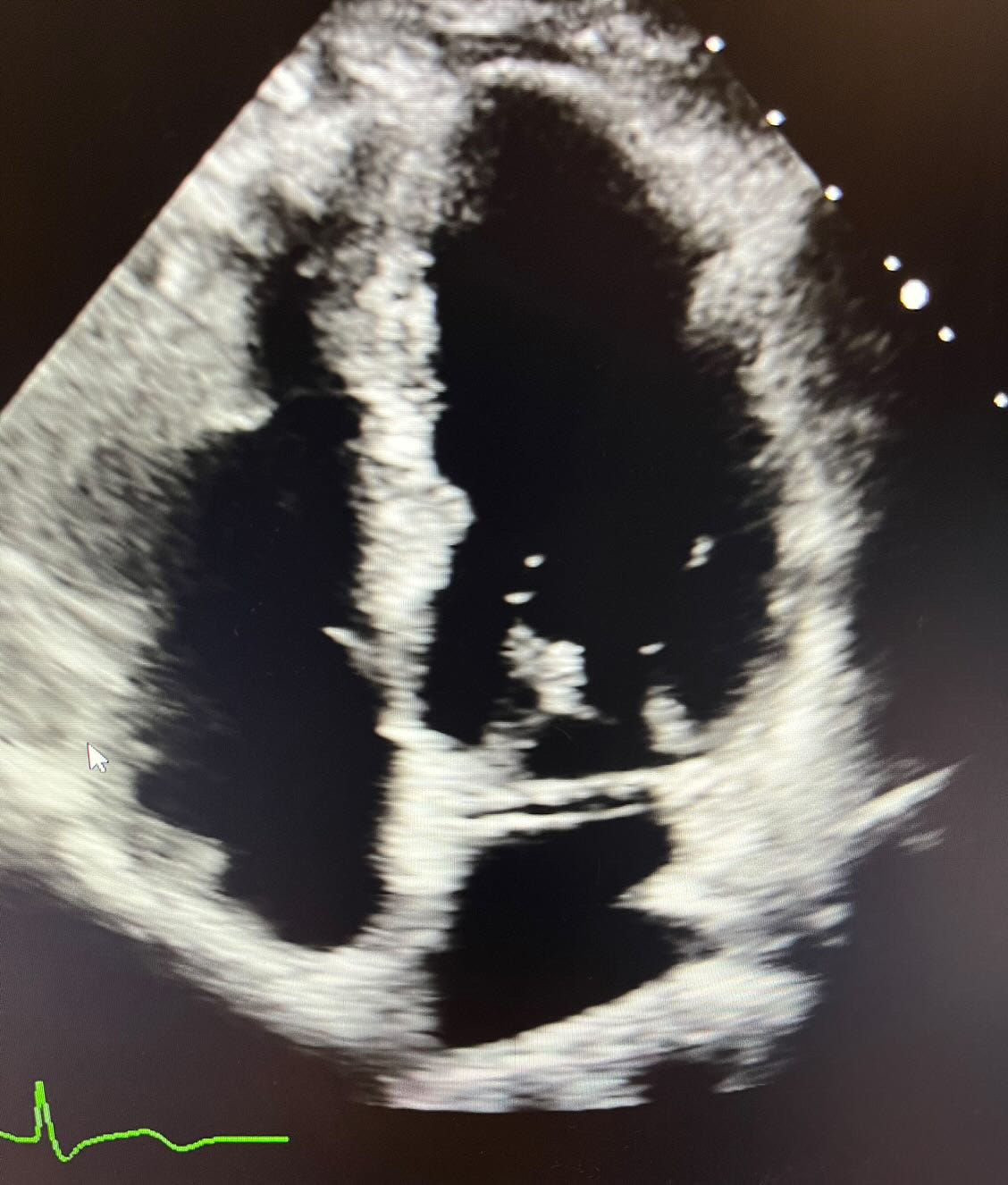 What?! Anomalous Coronary Arteries Seen with Echo