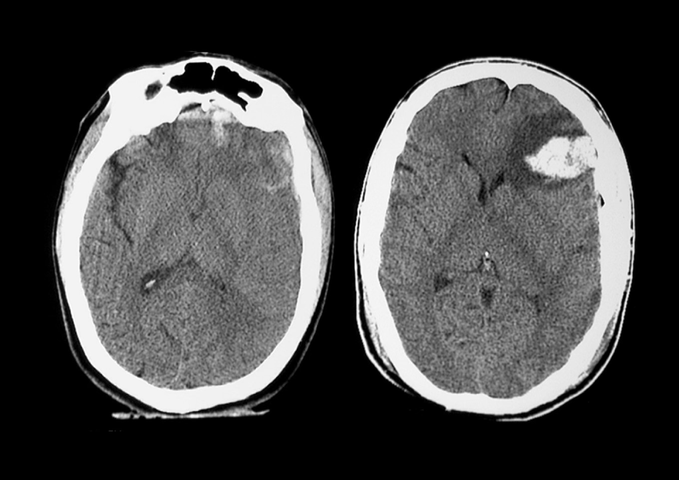 Cerebral contusion - by Alexander Baxter - RadNotes
