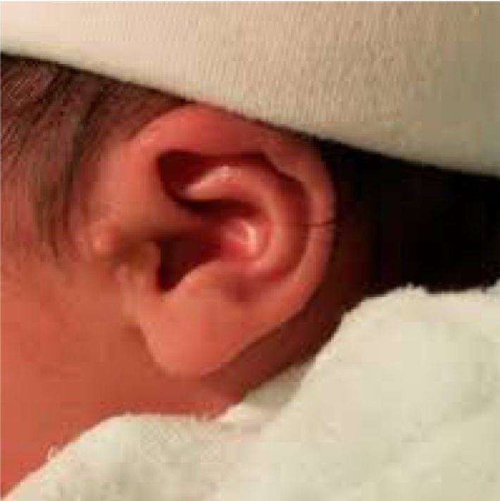 Pediatric Pearls: Infant's Ear - Pits, Tags, and the Pinna