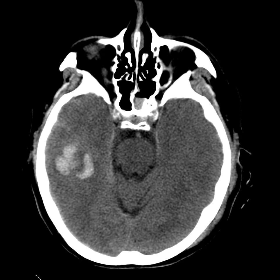 Cerebral contusion - by Alexander Baxter - RadNotes