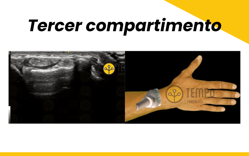 Compartimentos extensores de la muñeca - by Tempo Formación