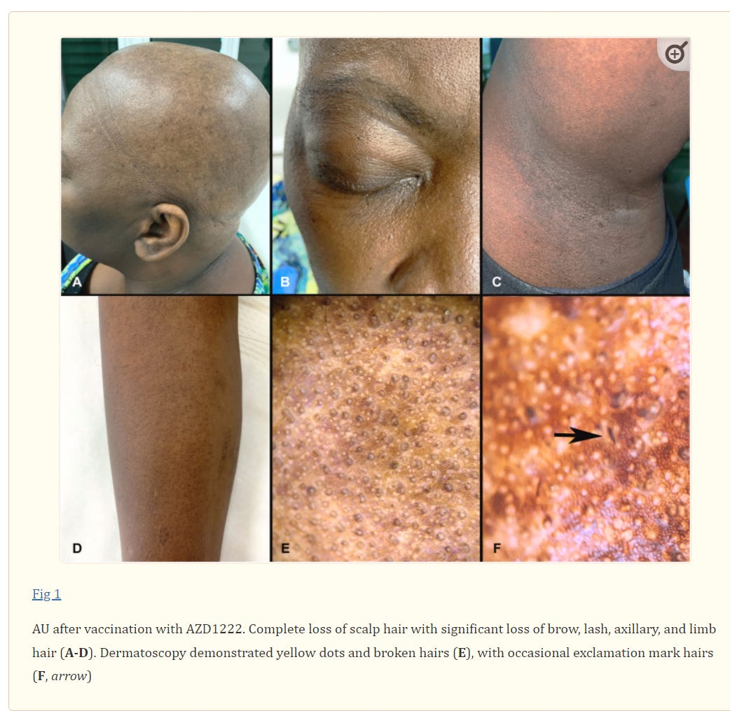 Cutaneous reactions to C-19 injections - by OUTRAGED HUMAN