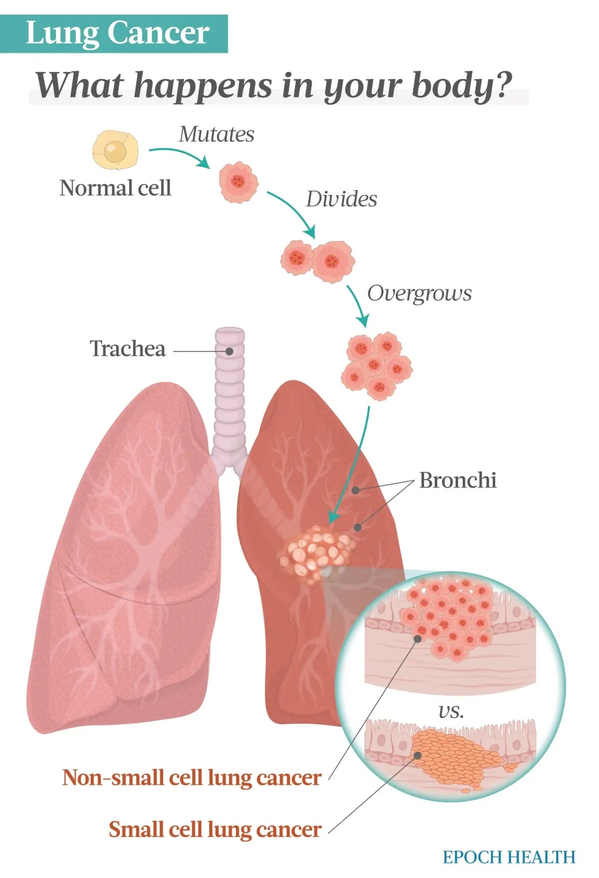 The Deadliest Cancer—With 17 Signs