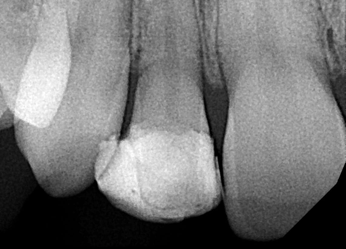 Peg Lateral Rejuvenation - by Brandon Walker, D.D.S.