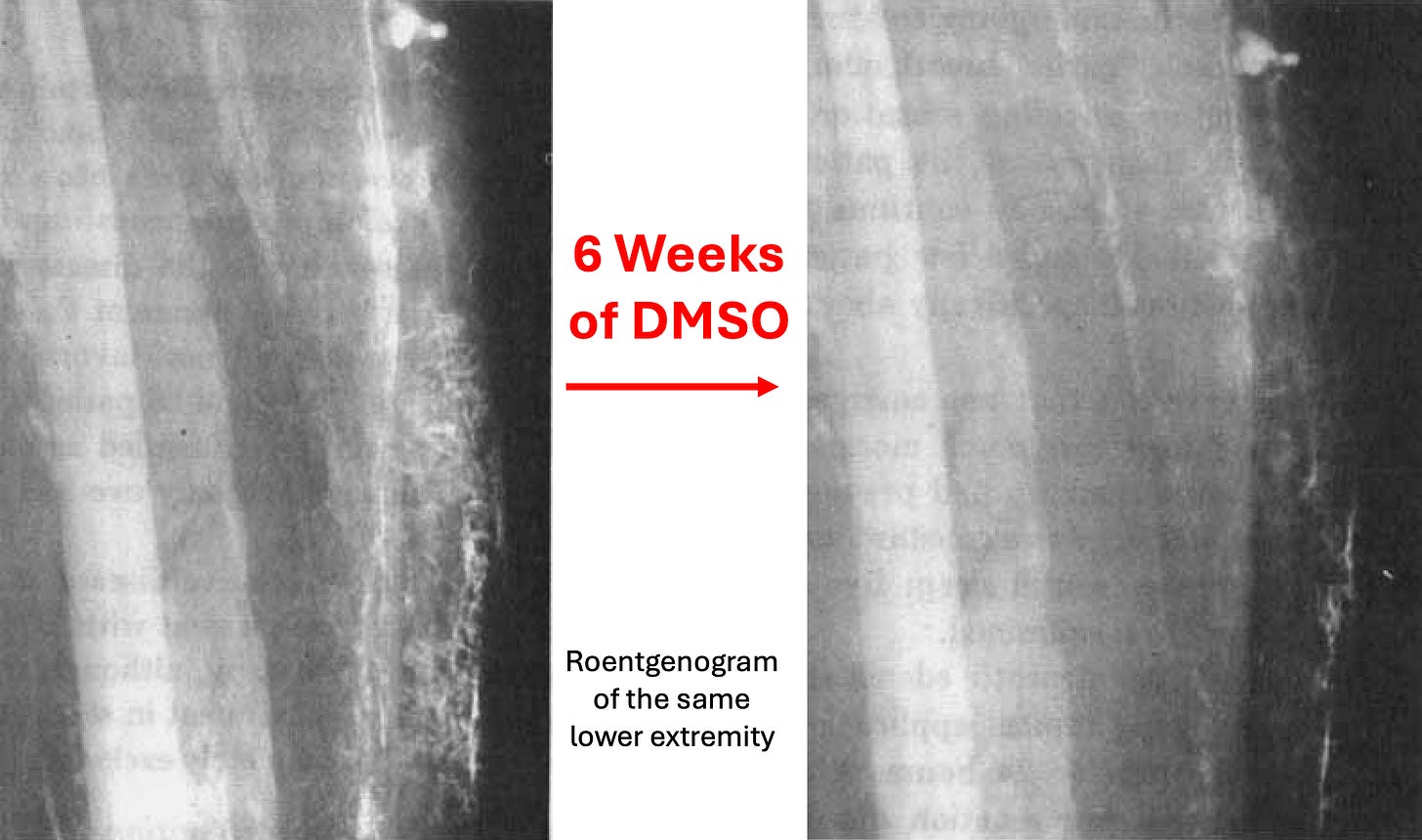 How DMSO Treats "Incurable" Autoimmune and Contractile Disorders