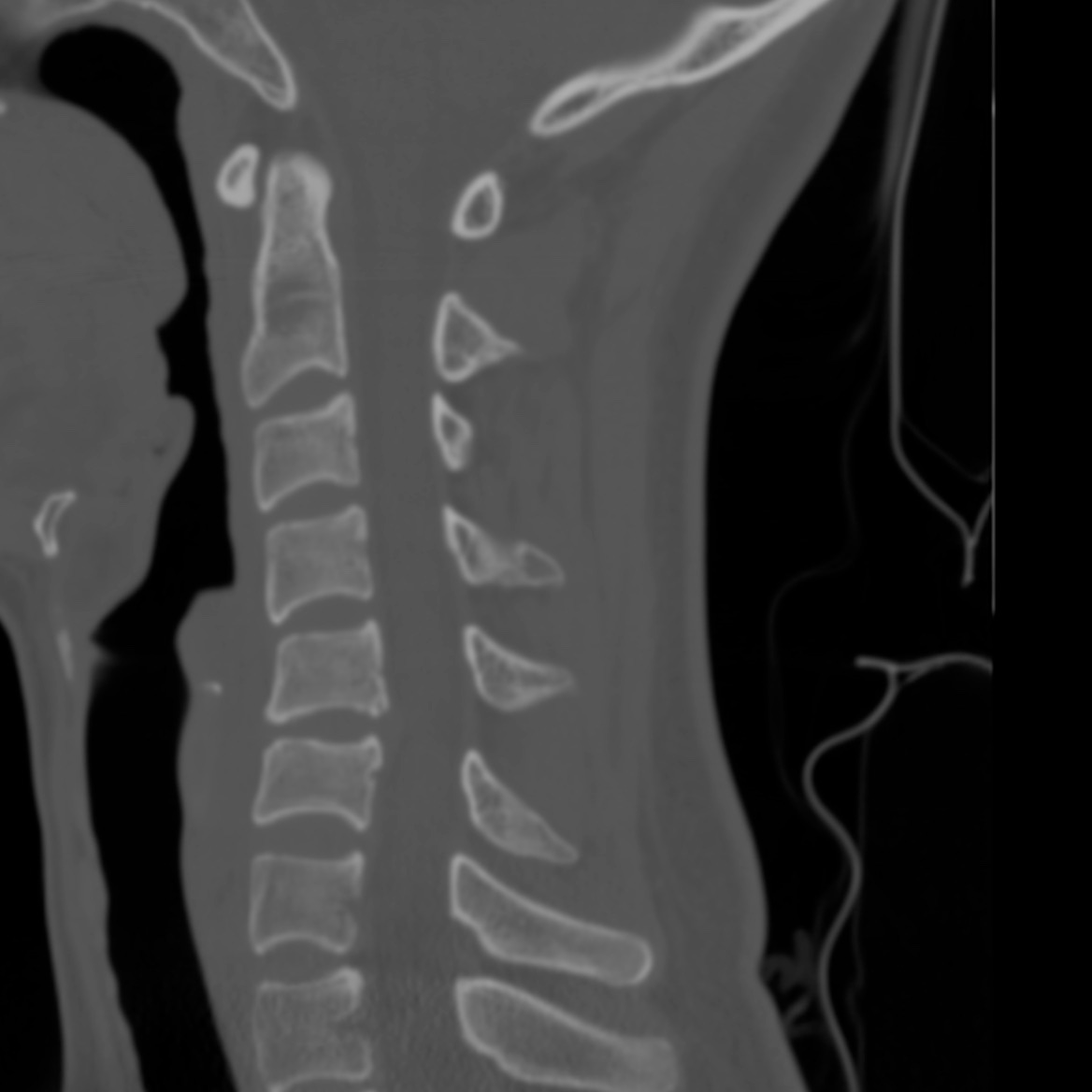 Cervical Spine Hyperflexion Injuries - by Alexander Baxter