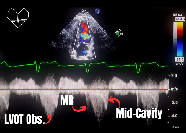 When Waves Collide: A Guide to Sorting Out Doppler Drama
