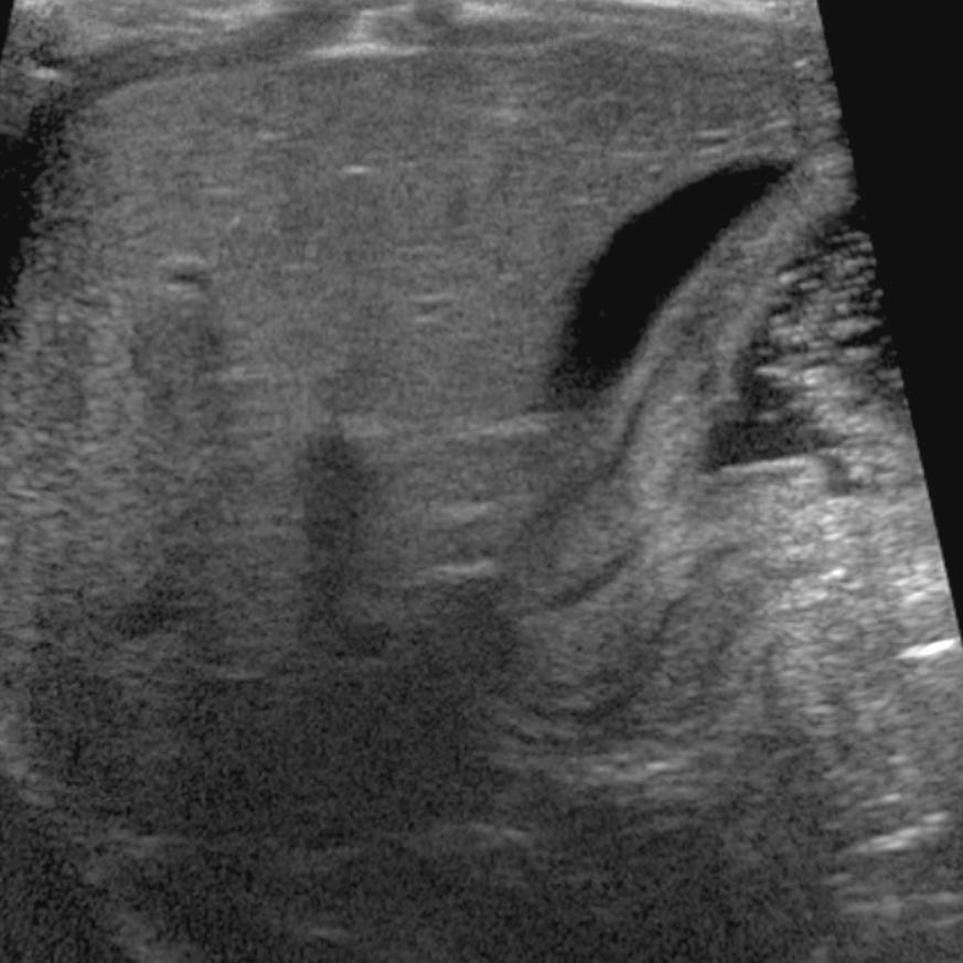 Pyloric stenosis - by Alexander Baxter - RadNotes