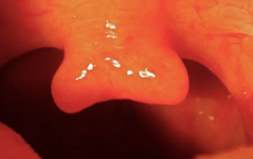 Pediatric Pearls: Infant's Mouth Part 1 - Blisters, Bumps and Clefts