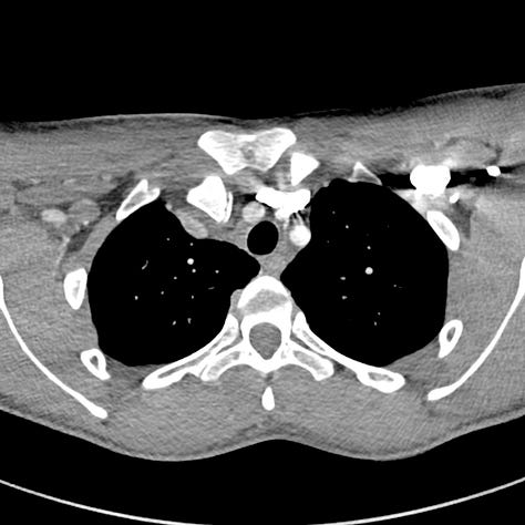 Chest wall injuries - by Alexander Baxter - RadNotes