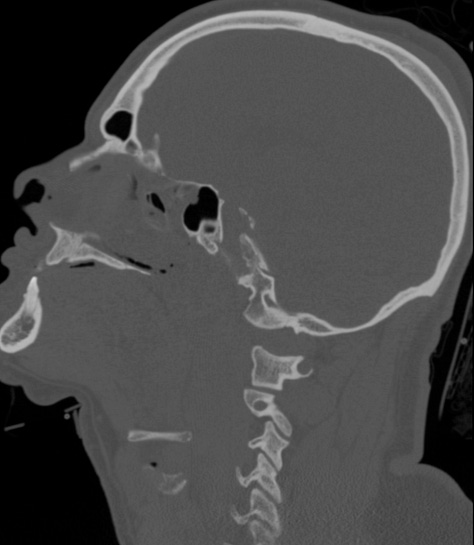 Atlantooccipital dislocation - by Alexander Baxter