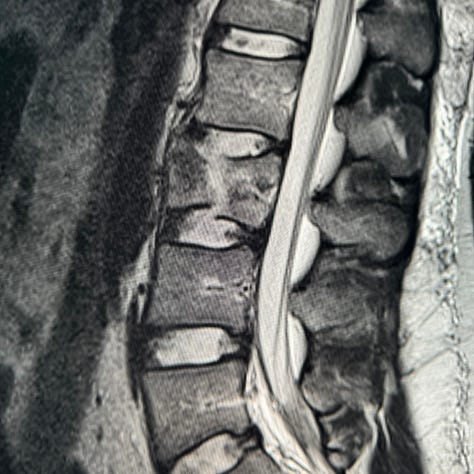 Vertebral compression fractures - by Alexander Baxter