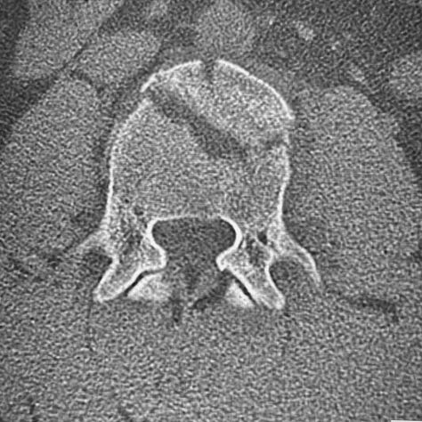Vertebral compression fractures - by Alexander Baxter