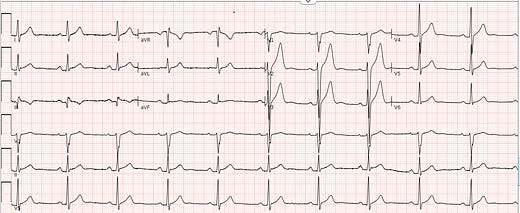 #4 - Knowing What to Expect from an Anterior versus Inferior Wall ...