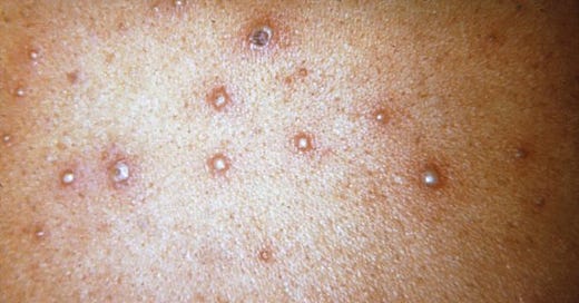 Outbreak News Today | Robert Herriman | Substack