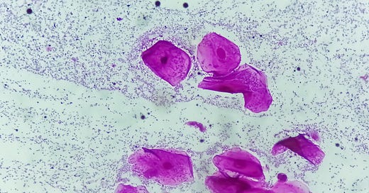 Bacterial Vaginosis - The Era of Treating Male Partners Has Arrived