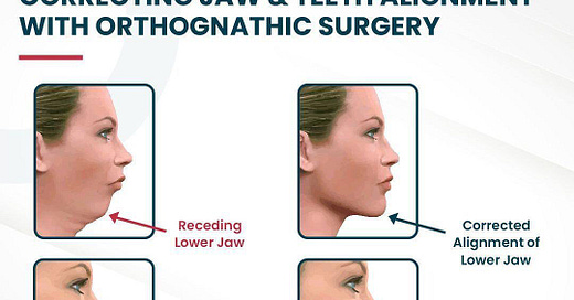 What is Prognathism? Identifying and Treating Jaw Alignment Issues