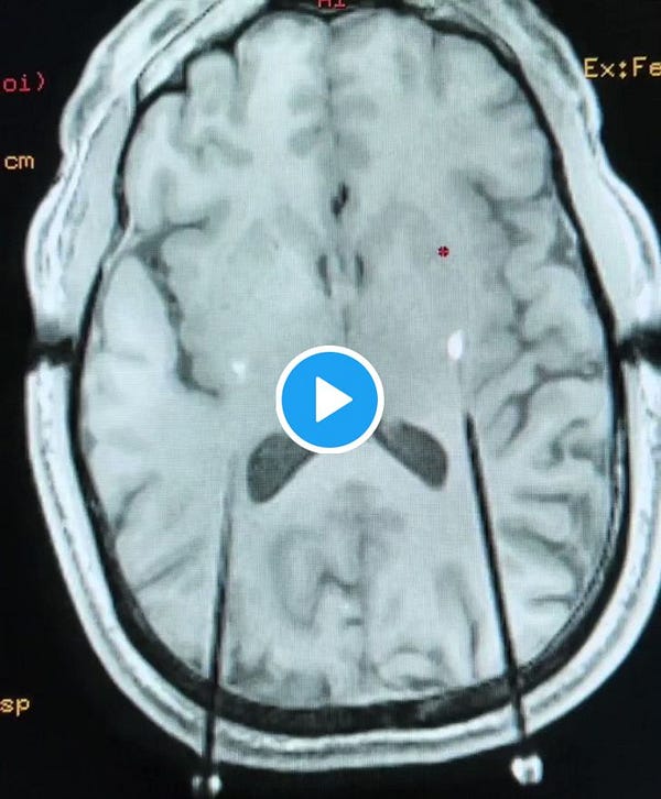 2# ClearPoint Neuro - Insane in The Brain?