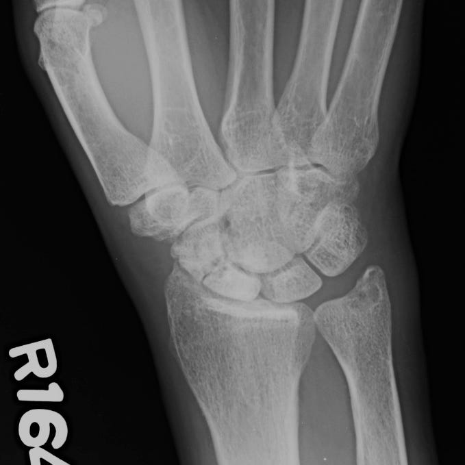 Scaphoid fracture and scapholunate dissocation