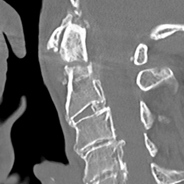 Odontoid (dens) fracture - by Alexander Baxter - RadNotes