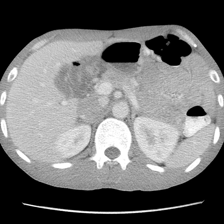 Duodenal perforation - by Alexander Baxter - RadNotes