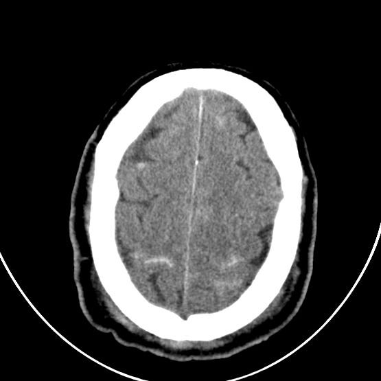 Interpeduncular Cistern Hemorrhage