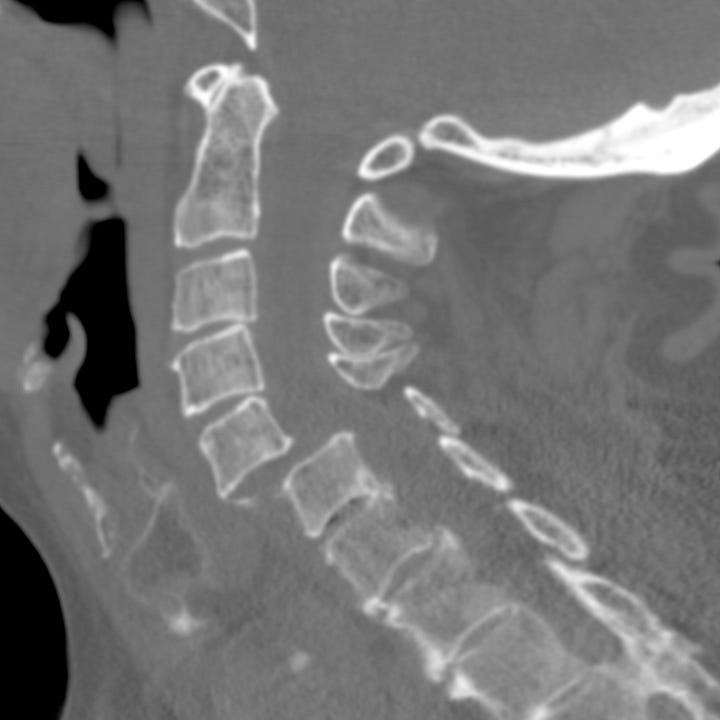 Cervical Spine Hyperflexion Injuries - by Alexander Baxter