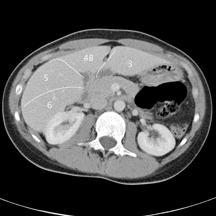 Hepatic segmental anatomy - by Alexander Baxter - RadNotes