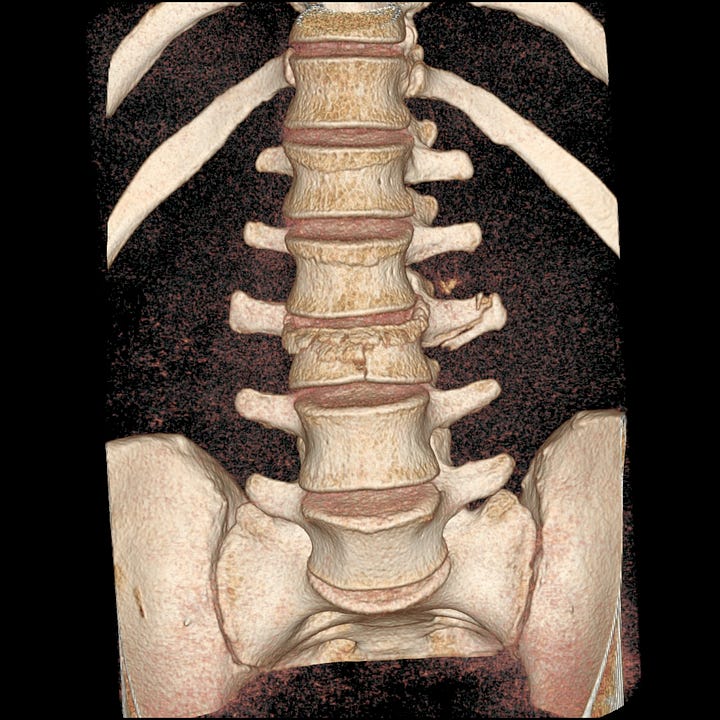 Vertebral compression fractures - by Alexander Baxter