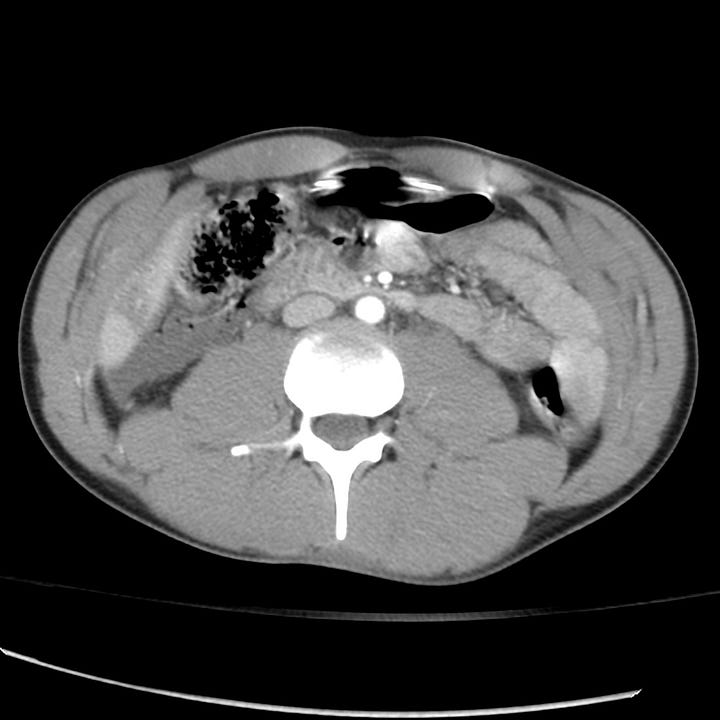 Duodenal perforation - by Alexander Baxter - RadNotes
