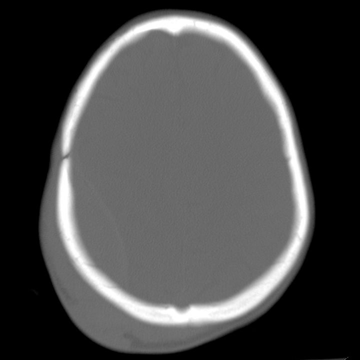 Epidural Hematoma - by Alexander Baxter - RadNotes