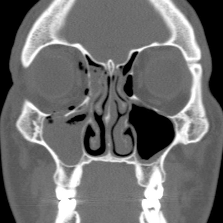 Orbital wall fractures - RadNotes