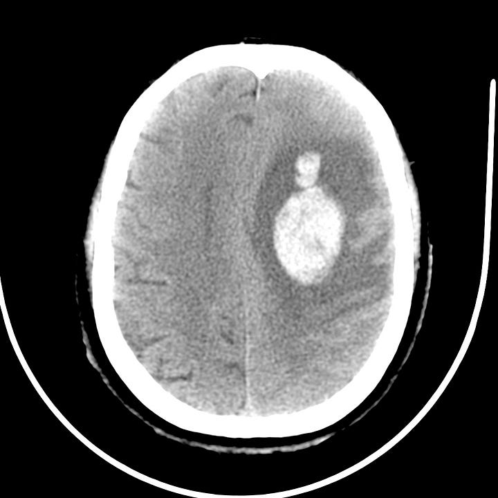 Cerebral edema patterns - by Alexander Baxter - RadNotes