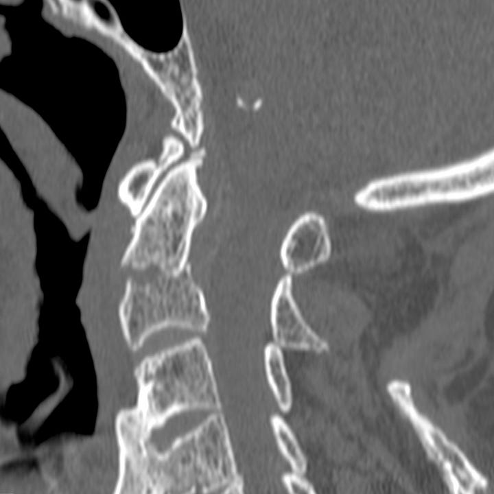 Odontoid (dens) fracture - by Alexander Baxter - RadNotes